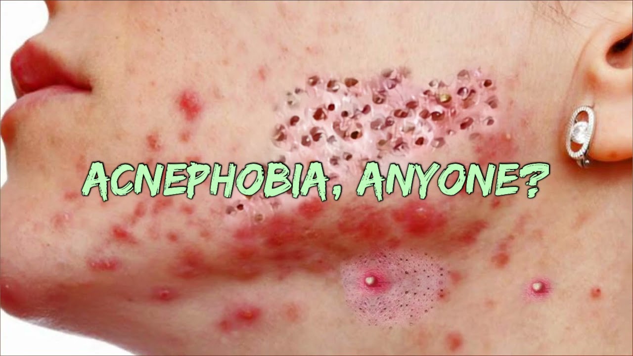 Acnephobia! Fear of Pimples, Acne, Blemishes, Blackheads, Comedones and ...