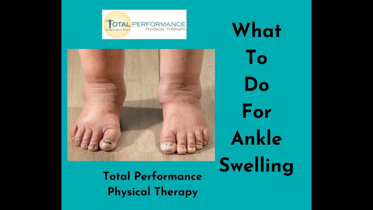 What to Do for Ankle Swelling - YouTube