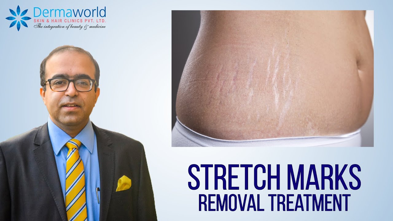 Stretch Marks Eraser Laser Treatment | How to remove stretch mark - YouTube