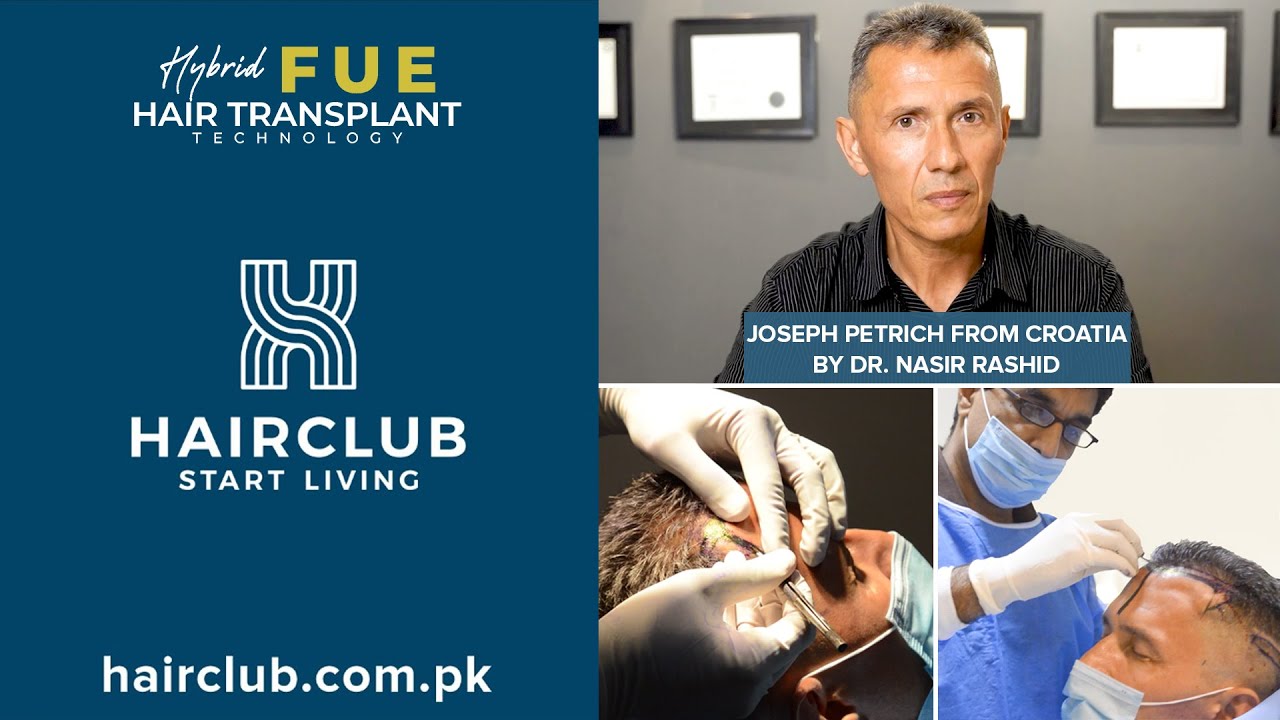 Joseph Petrich from Croatia Gets Hybrid Hair Transplant with DHI ...