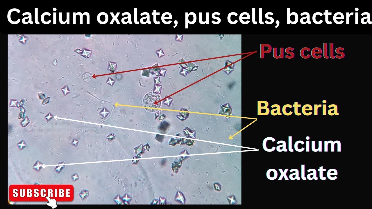 Pus cells, Calcium oxalate and Bacteria under microscope ...