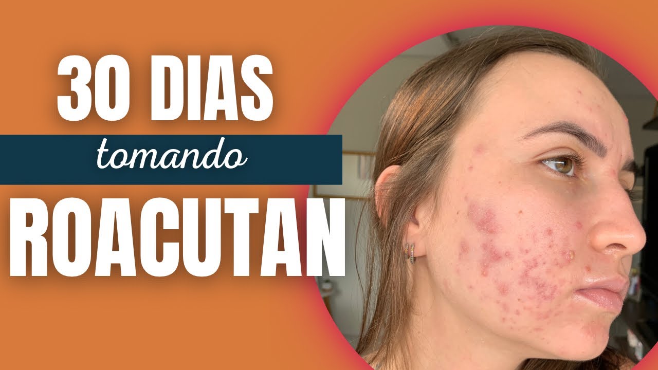 30 DIAS TOMANDO ROACUTAN - Efeitos colaterais | produtos | curiosidades ...