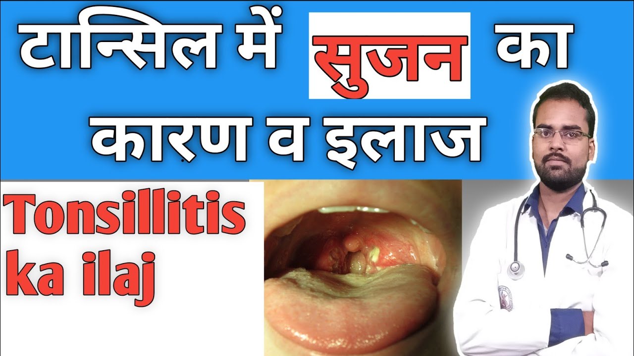 टान्सिल मे सुजन का कारण व इलाज ! Tonsillitis kya hota hai! Tonsils me ...
