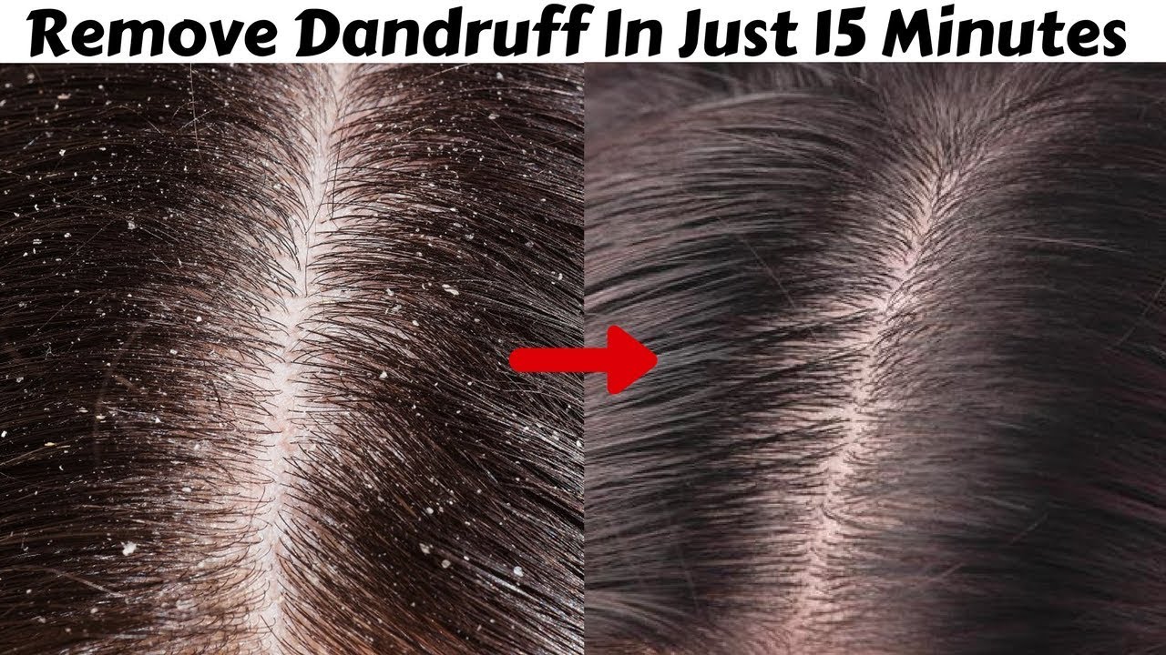 How To Remove Dandruff In Just 15 Minutes | Magical Hair Mask To Remove ...
