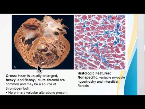 Pericarditis / Myocarditis / Cardiovascular Lesion / Syphilis / CVS ...