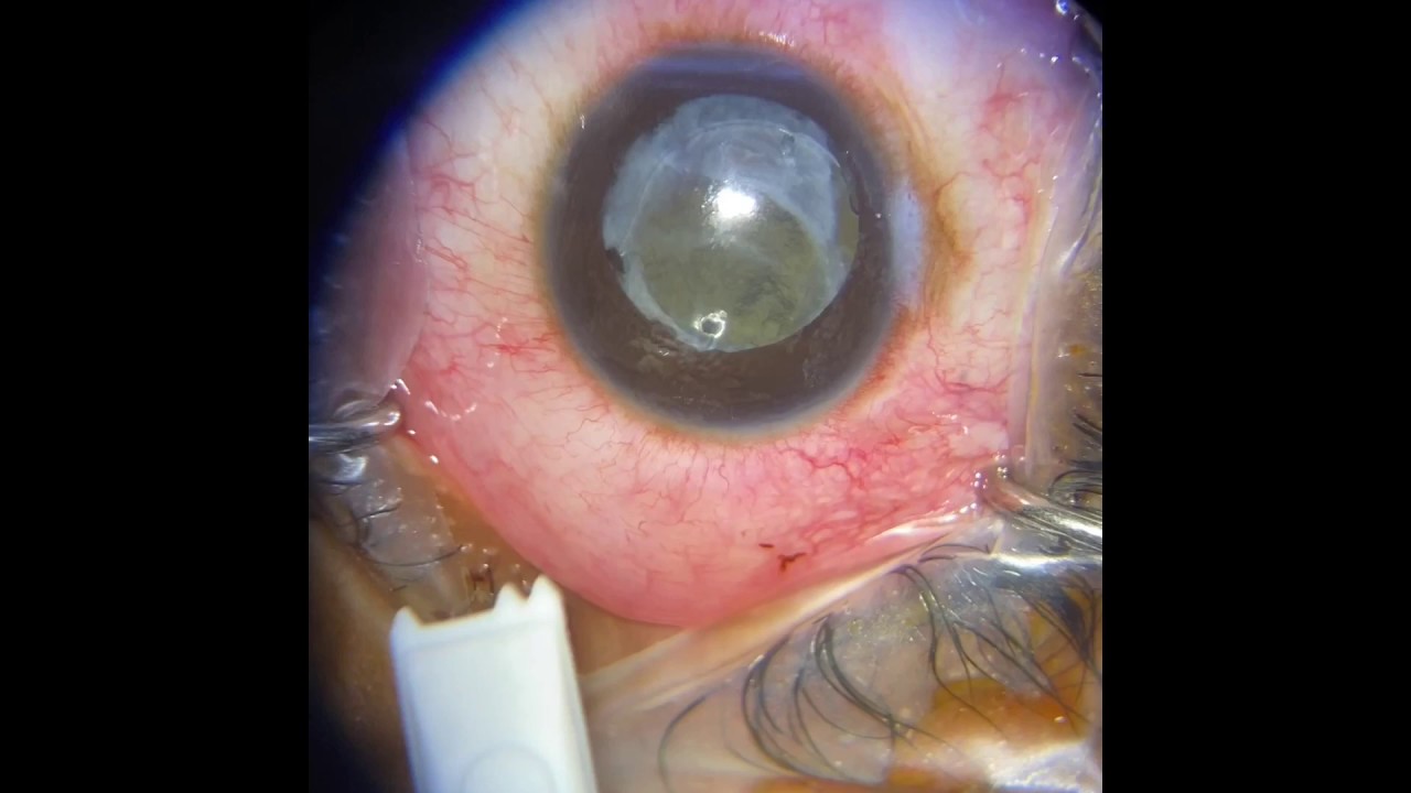 RETINA: PPV for Complicated (Funnel Shape RRD PVR C+++ - YouTube