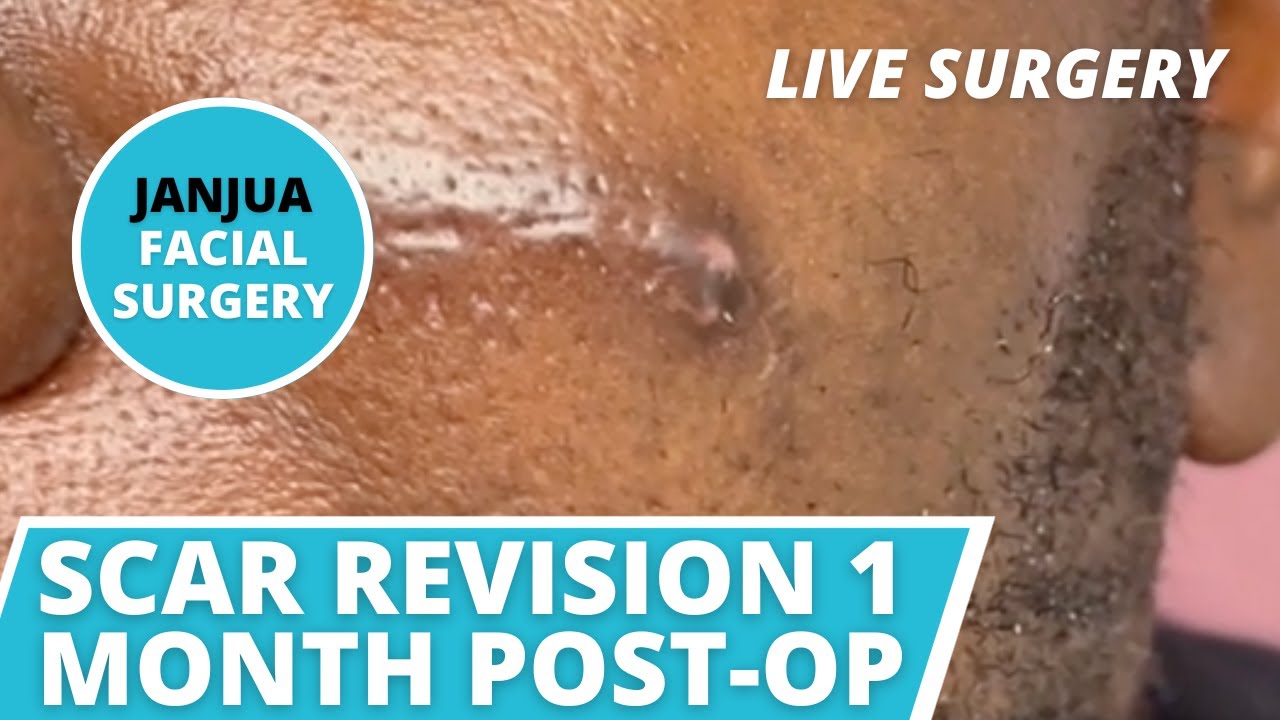 Scar Revision On Cheek Live Surgery Dr Tanveer Janjua New Jersey
