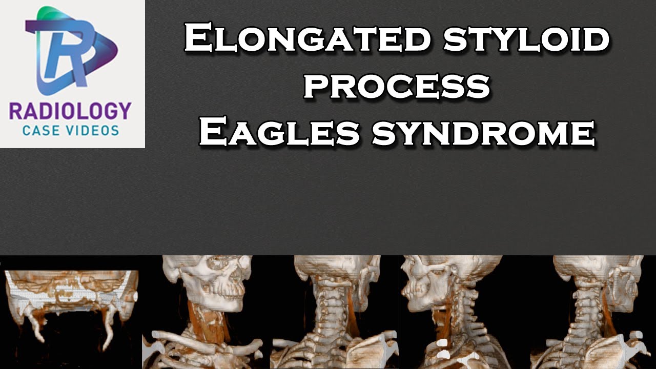 Elongated styloid process - Eagles syndrome - YouTube