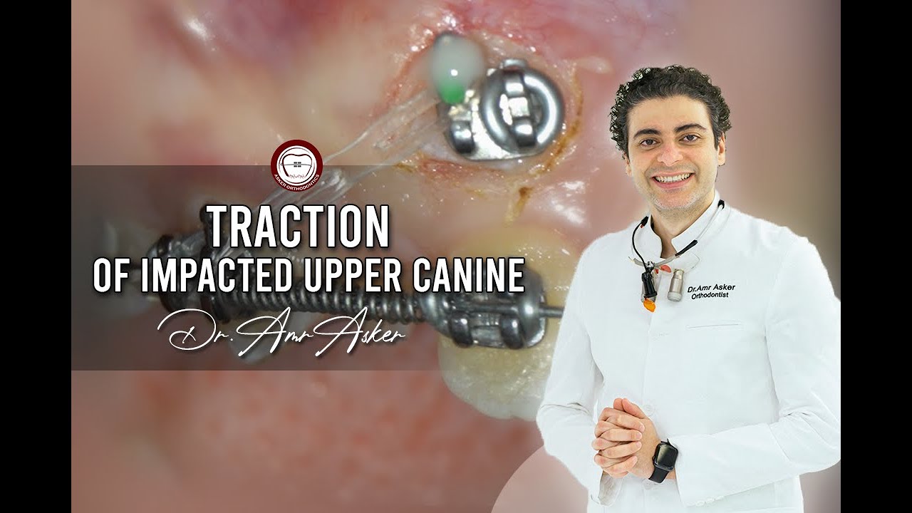 Open eruption technique for impacted transposed cuspid - YouTube