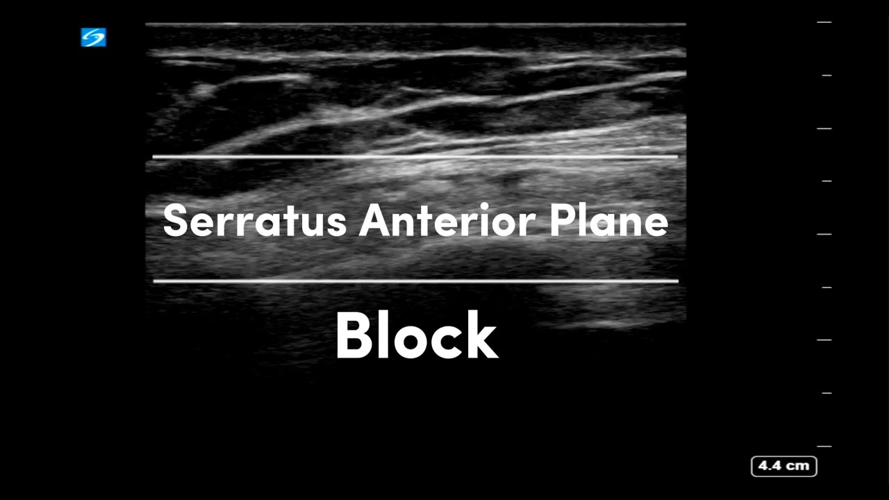Serratus Anterior Plane Block - YouTube