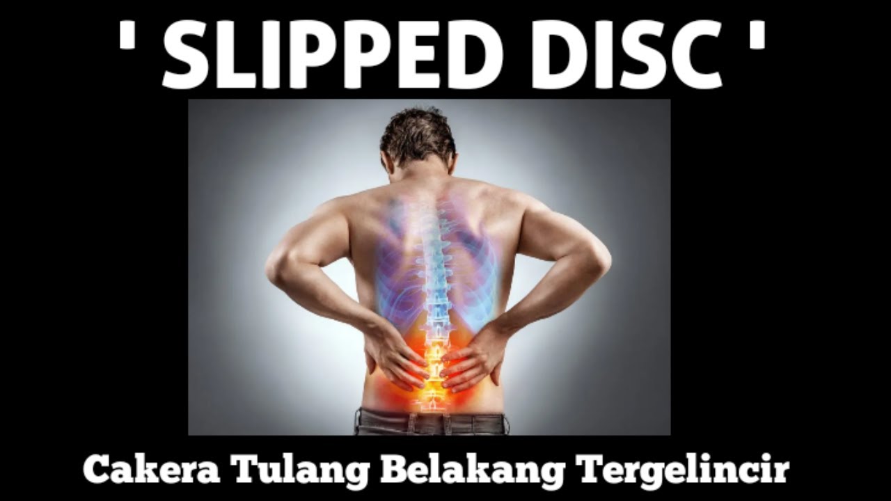 SLIPPED DISC (CAKERA TULANG BELAKANG TERGELINCIR) - SIMPTOM, PUNCA ...