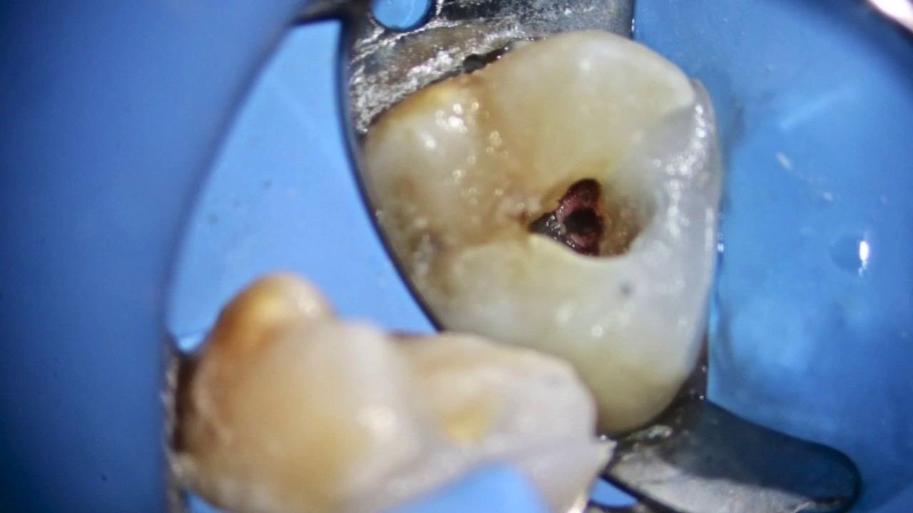 access cavity preparation, minimal invasive endodontics - YouTube