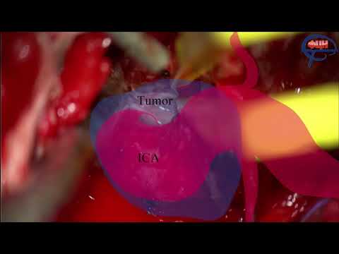 Giant residual pituitary macroadenoma. Extended transbasal approach ...