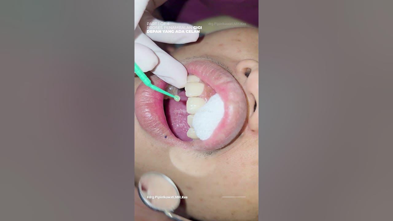 PROSES PENAMBALAN GIGI DEPAN YANG ADA CELAH || PART 1 OF 4 - YouTube