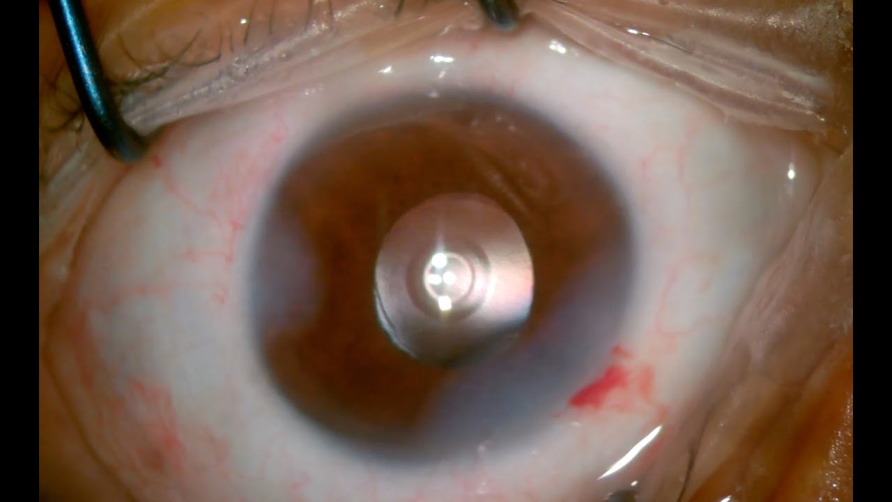 Non-toric Acrysof® IQ Vivity® IOL implant - Unifesp - YouTube