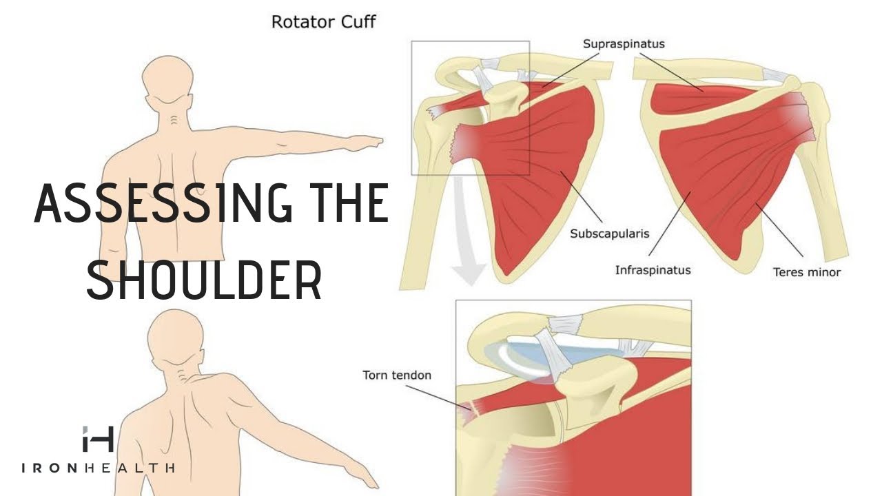 Does Your Doctor Assess Your Shoulder? | Iron Health - YouTube