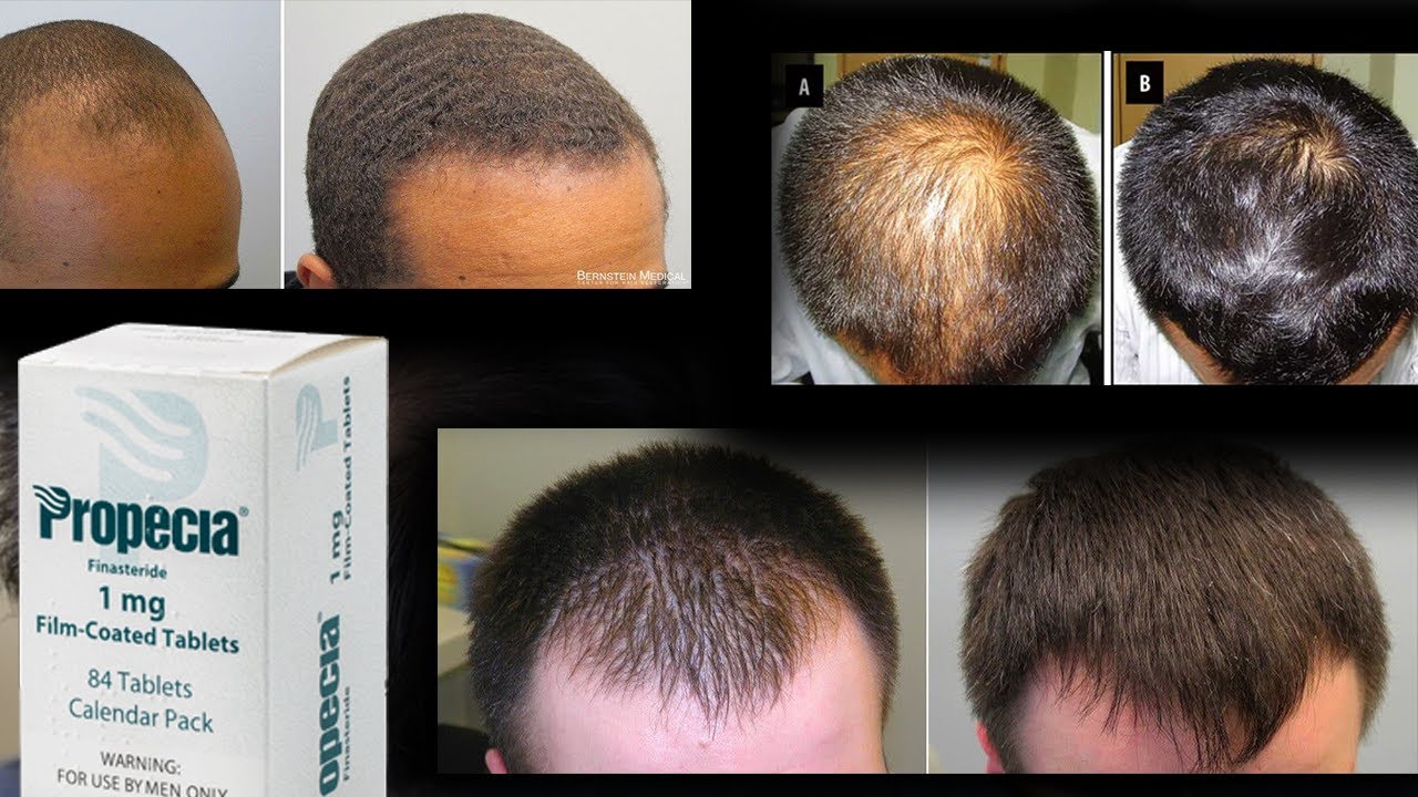 Long Term Finasteride Reverses Hair Loss: Stepwise Follicular ...
