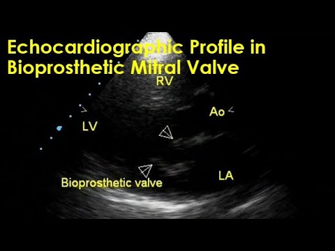 Echocardiographic profile of bioprosthetic mitral valve - YouTube