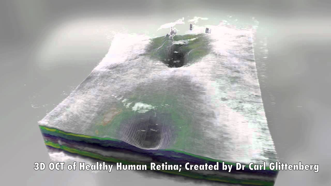 3D OCT of Healthy Macula (Focus on Vitreous) - YouTube
