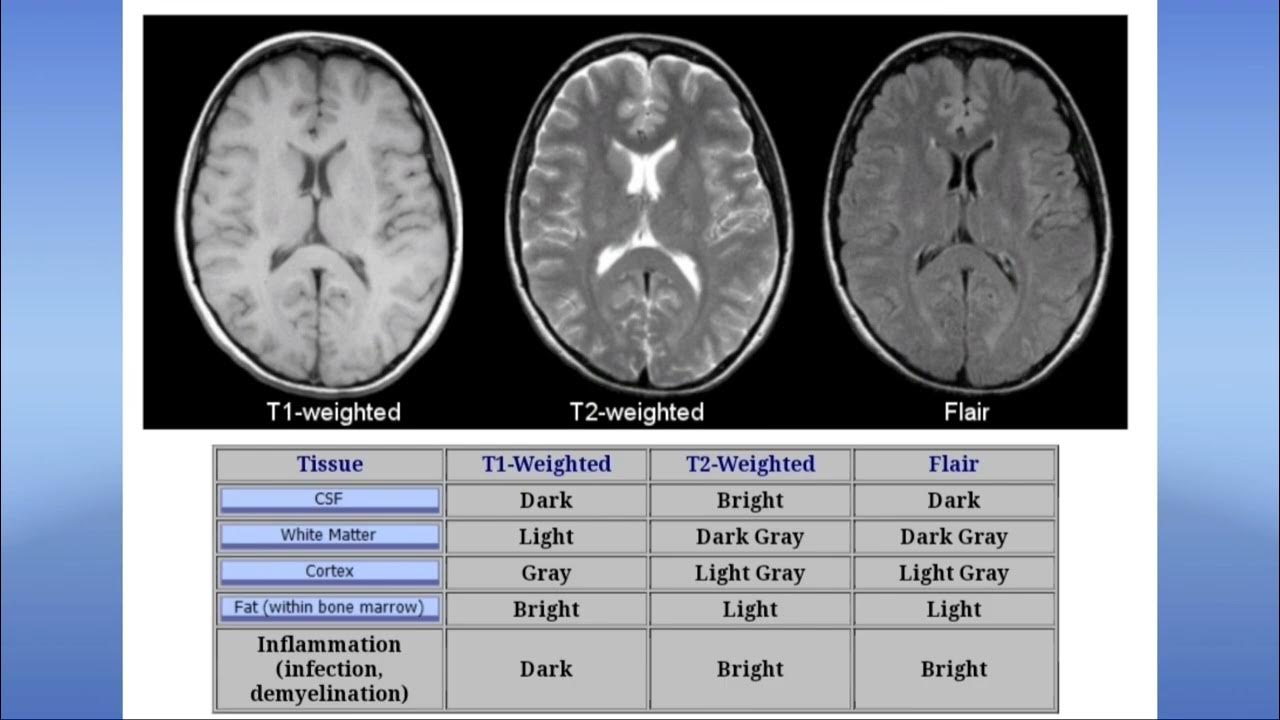 T1 T2 Flair Dwi image in MRI । MRI Sequences made easy - YouTube
