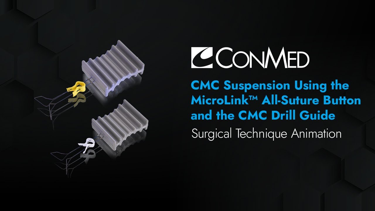 CMC Suspension Using MicroLink™ and CMC Drill Guide - CONMED Animation ...