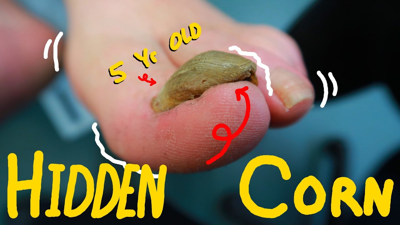 Hidden Corn & Nail Removal UNDER 5 Year old NAIL! - YouTube