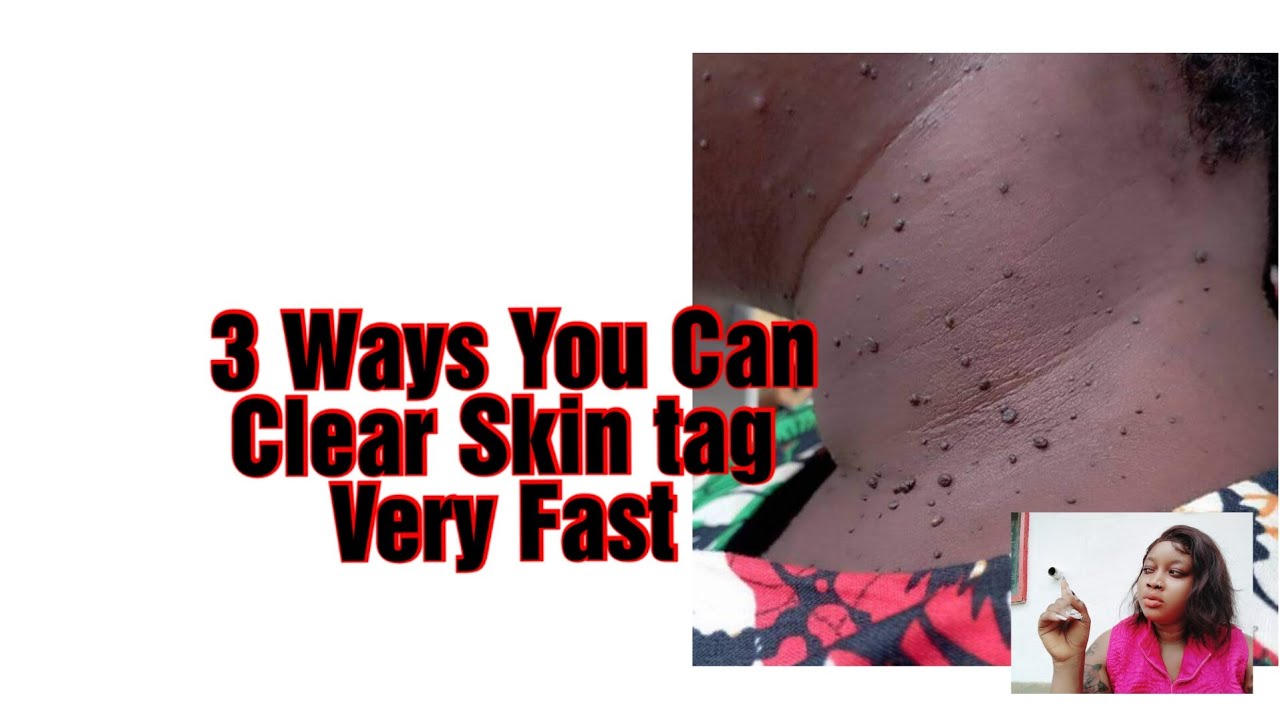 FAST WAYS TO GET RID OF SKIN TAG #newvideo #skincare #skinwhitening ...