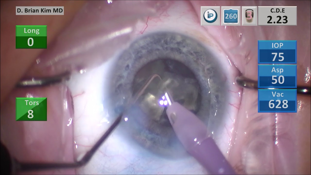 The Best Way To Do Cataract Surgery #19: Dense Cataract, Medium Pupil ...