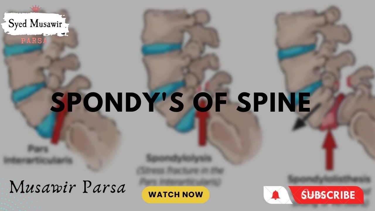 SPONDY'S OF SPINE | Spondylosis| Spondylitis| Spondylolysis ...