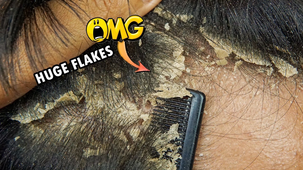 Huge Flakes Of Dandruff Scratching Satisfying 715 Youtube