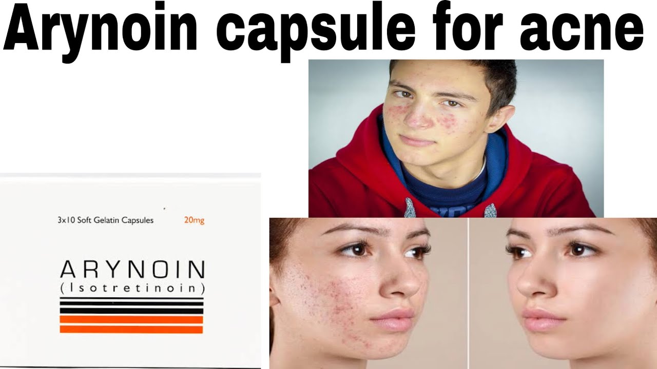 Arynoin capsule| isotrerinoin| Benefits|How to use arynoin cap| remove ...
