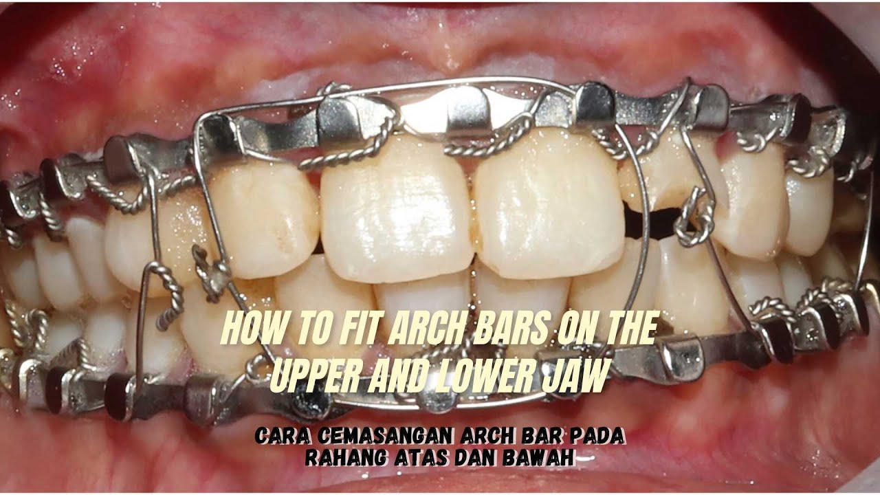 How to fit arch bars on upper and lower jaws - YouTube