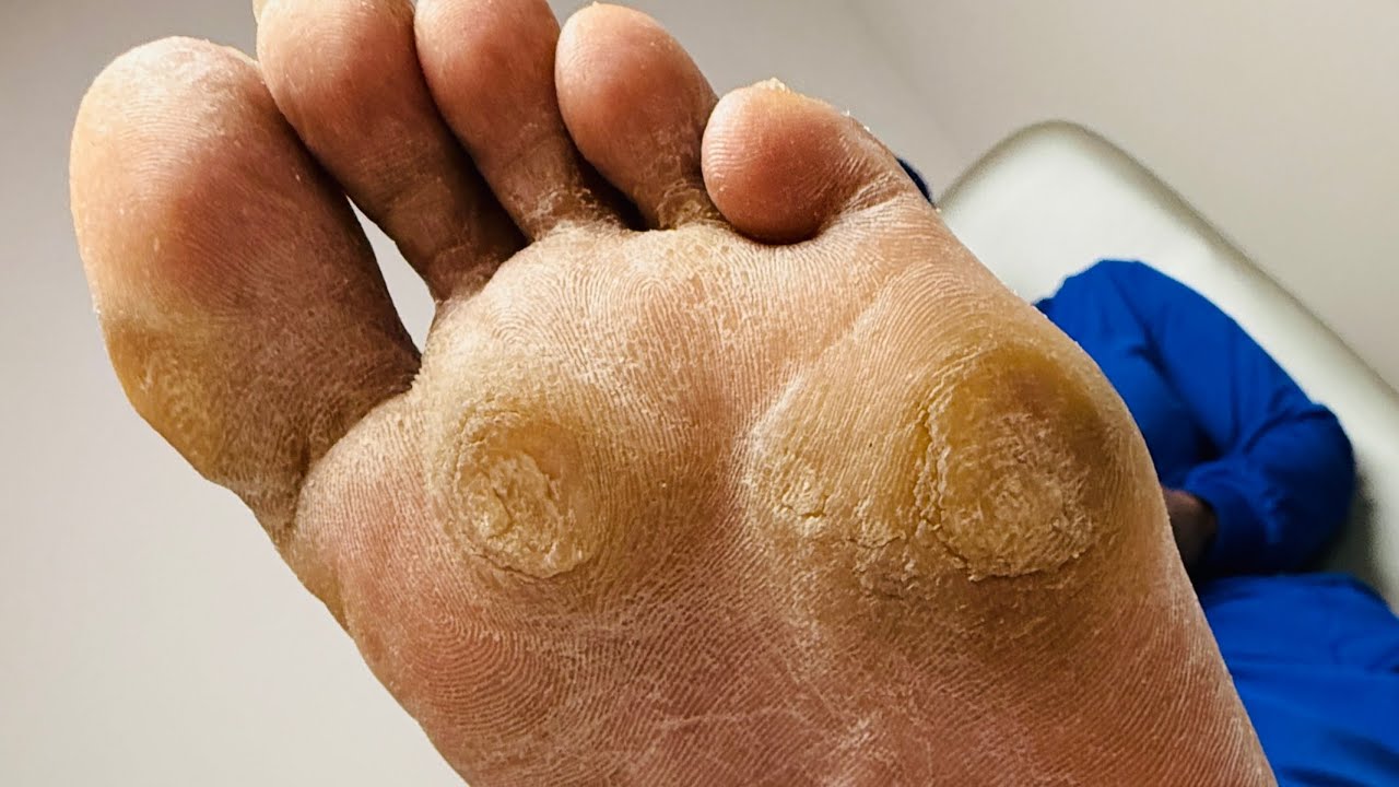MONSTER FOOT CALLUS REMOVAL Part 2 - Very Satisfying - YouTube