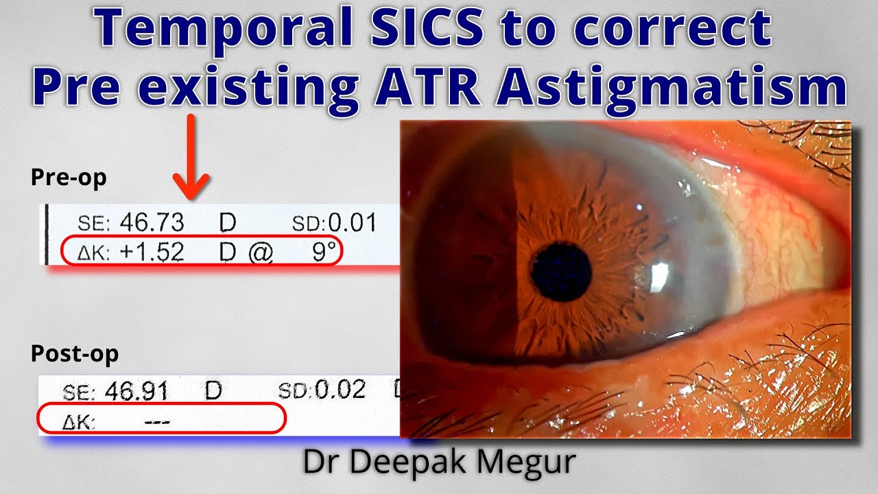 Manual SICS -Temporal Incision to correct Pre-Existing Against The Rule ...
