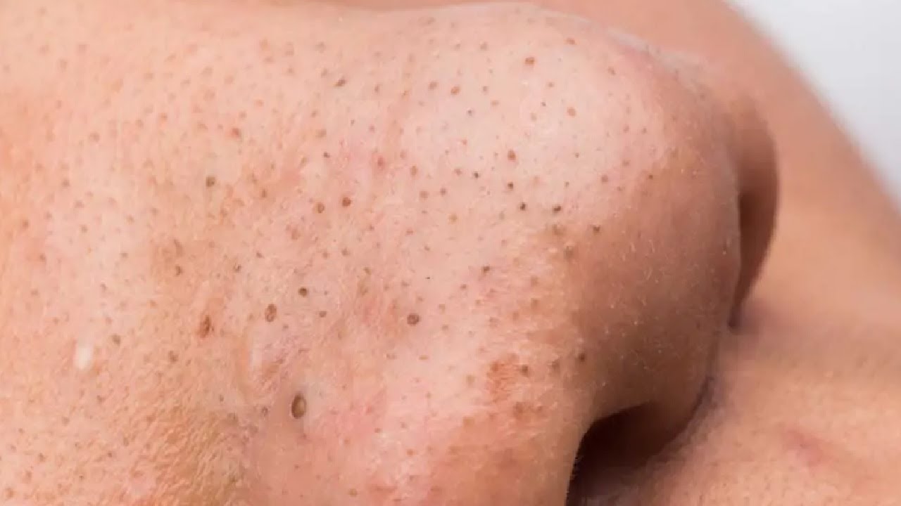 easiest way to get rid of blackheads on nose with floss - YouTube