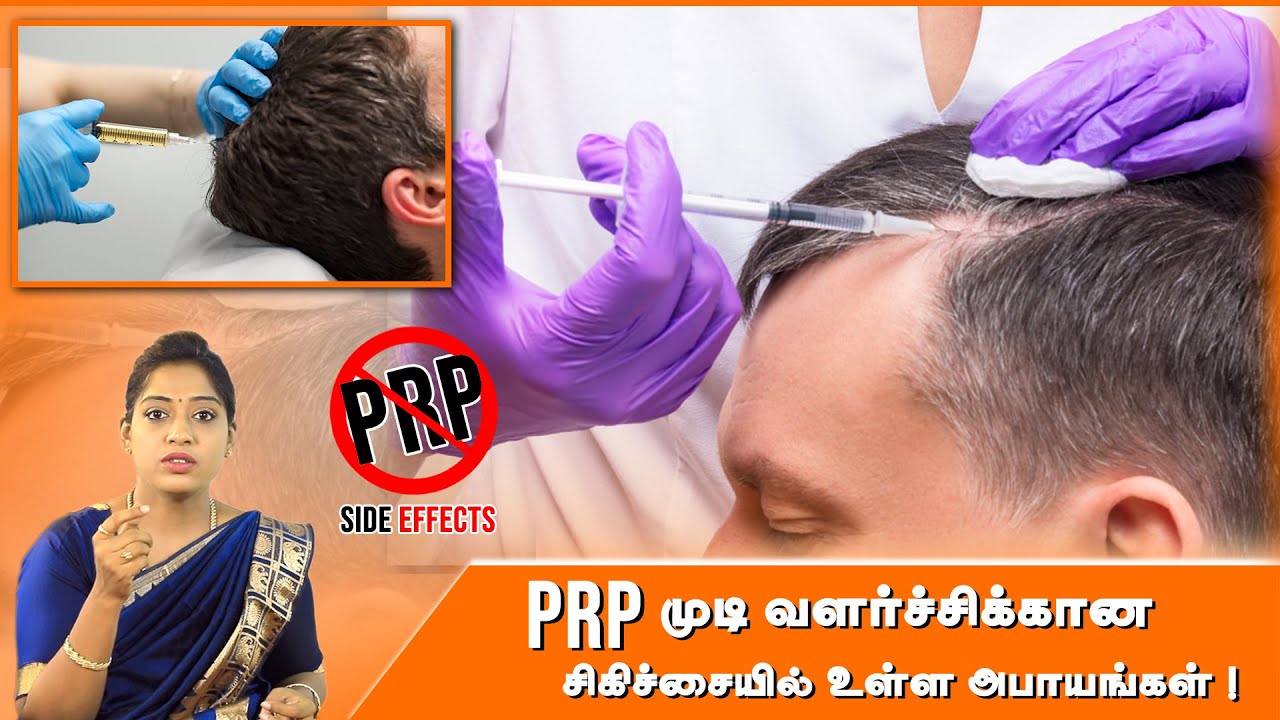 P R P முடி வளர்ச்சிக்கான சிகிச்சையில் உள்ள அபாயங்கள் ! prp side effects ...