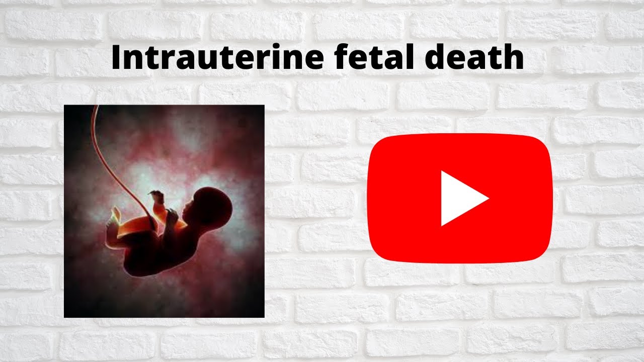 Intrauterine fetal death - YouTube