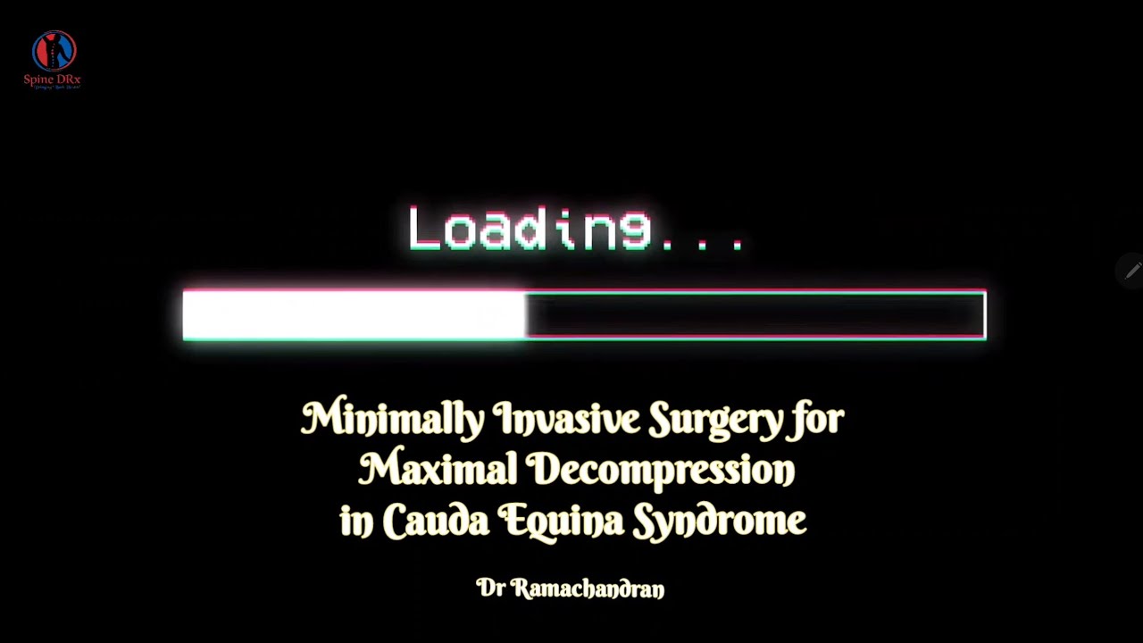 Minimally invasive Surgery for Cauda Equina Syndrome - YouTube