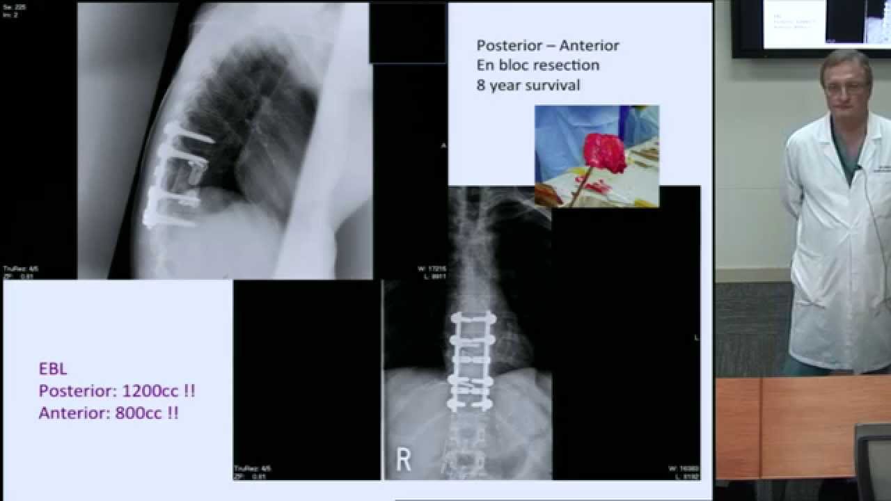 Spine Stabilization Techniques for Spine Tumors by Jens Chapman, M.D ...