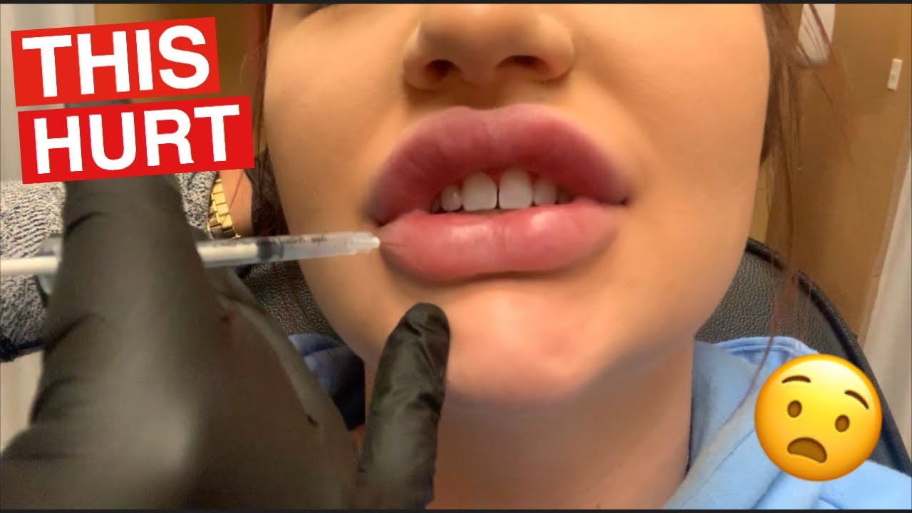 GETTING MY BOTCHED LIP FILLERS DISSOLVED - YouTube
