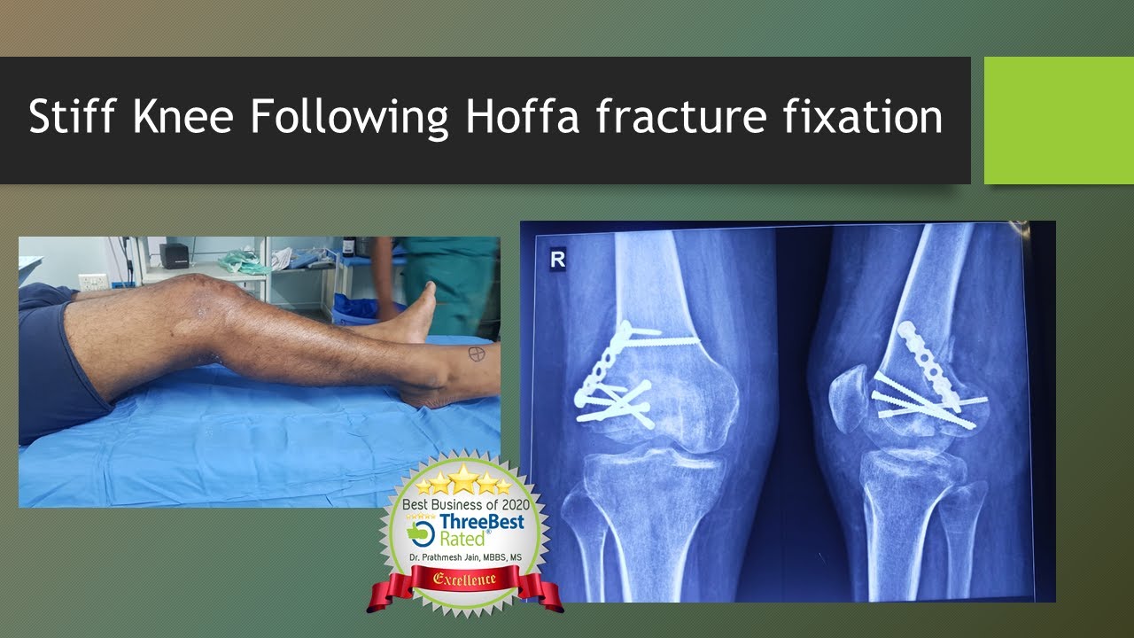 Stiff Knee following Hoffa Fracture : Arthroscopic Treatment - YouTube