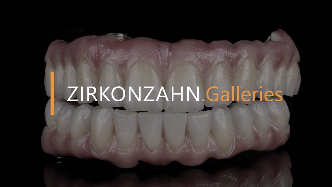 Prettau® Bridges made of Prettau® 2 Dispersive® on Anodised Titanium ...