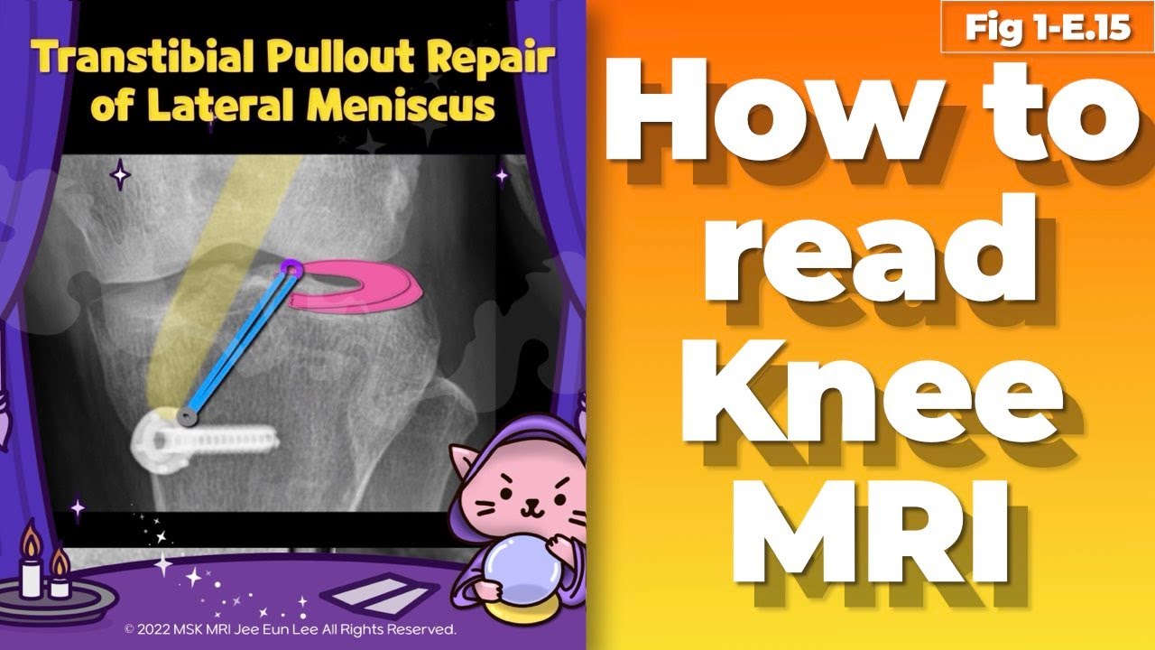 (Fig 1-E.15) Transtibial Pullout Repair of Lateral Meniscus Posterior ...