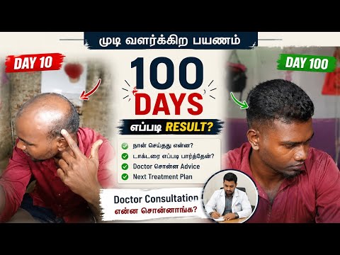 முடி வளர்க்கிற பயணம் Day 100 💯 | Real Result & Doctor Advice