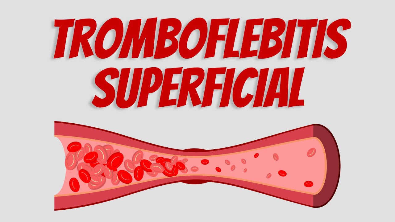 Trombosis Venosa Superficial Explicado Claramente - YouTube