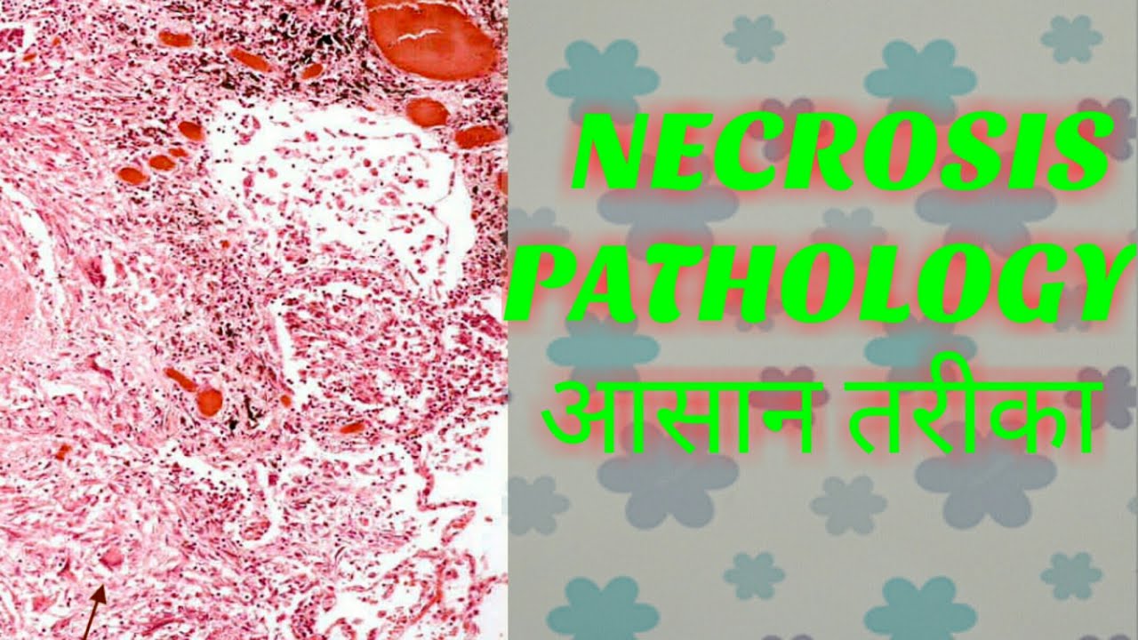 Necrosis General Pathology In Hindi YouTube necrosis-general-pathology-in-hindi-youtube