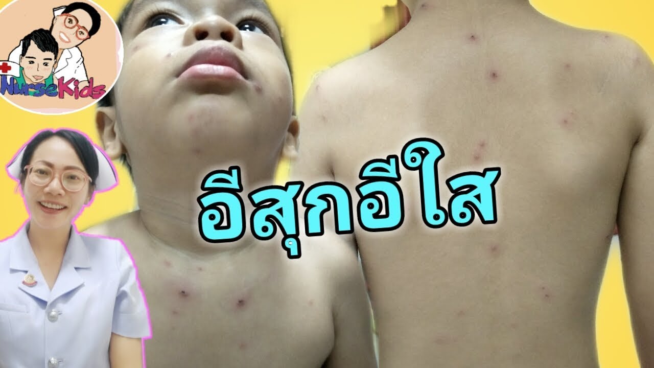 ละครสั้นอีสุกอีใส(Chickenpox)เกิดจากอะไร กี่วันหาย และวัคซีนป้องกัน - YouTube