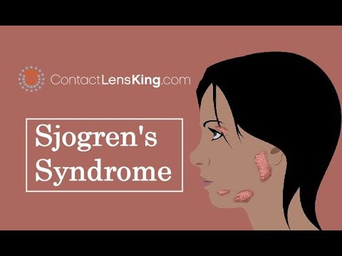 Sjogren's Syndrome Dry Eyes and Mouth | What is it and How is it ...