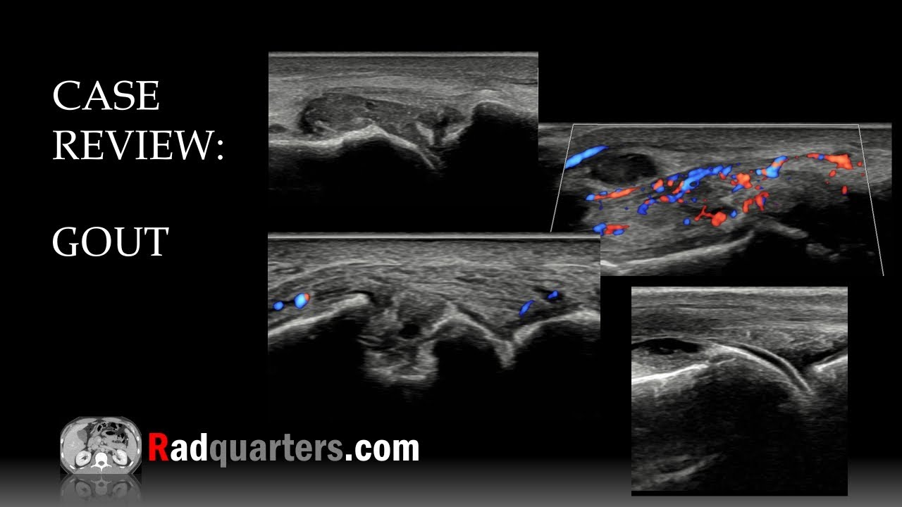 Ultrasound of Gout - YouTube