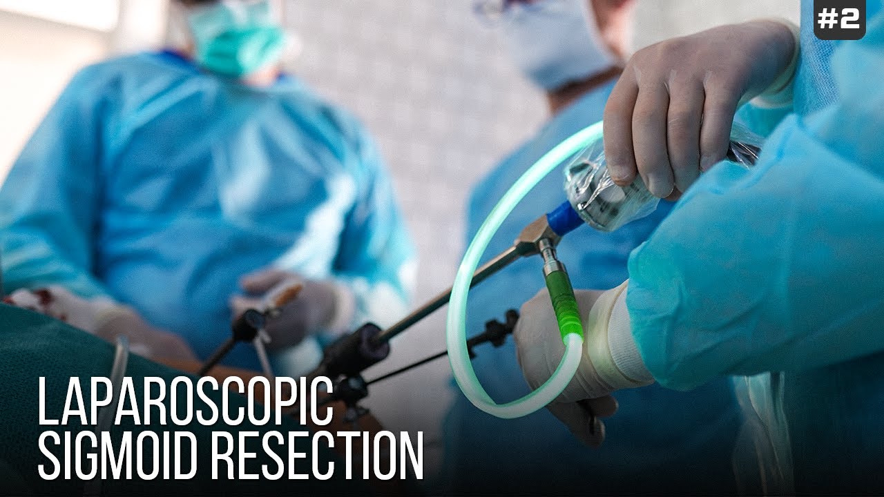 Laparoscopic sigmoid resection #2 - YouTube
